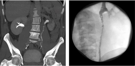 Image result for Volume-Rendered CT Urogram
