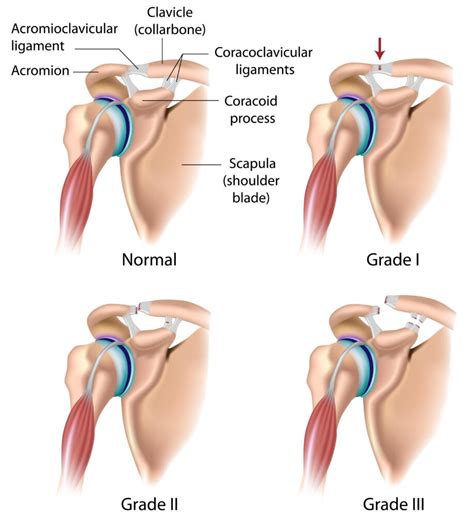 Image result for AC Joint Dysfunction