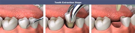 Image result for Lower Tooth Extraction