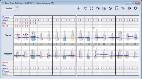Image result for Paper Perio Chart
