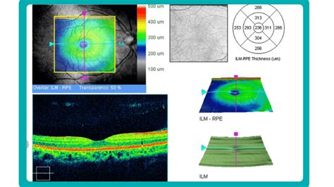Image result for Oct Interpretation
