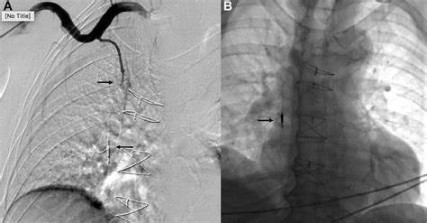 Image result for Angiogram with Embolization