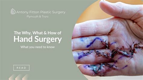 Image result for Hand Surgery Procedure