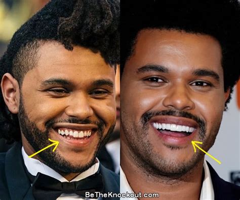 Image result for The Weeknd Botox