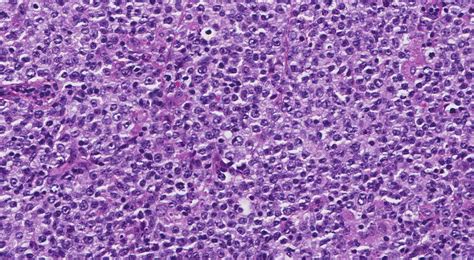 Image result for Diffuse Large Cell Lymphoma