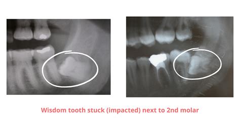 Image result for Wisdom Tooth Overlap