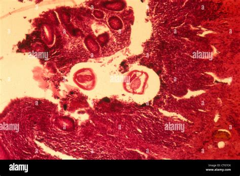 Image result for Pinworm Skin