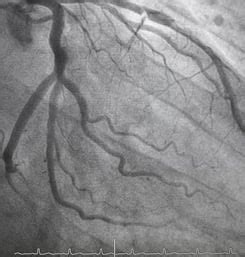 Image result for Peripheral Angiogram