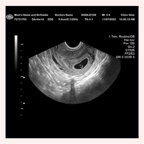 4 Week Ultrasound - Ultrasounds
