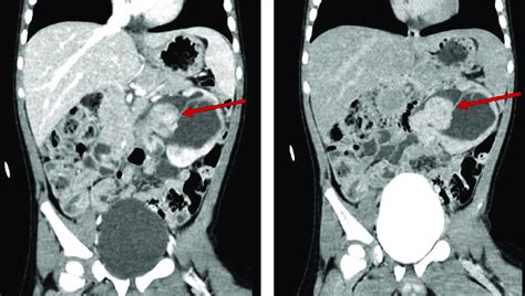 Image result for Delayed Phase CT Urogram