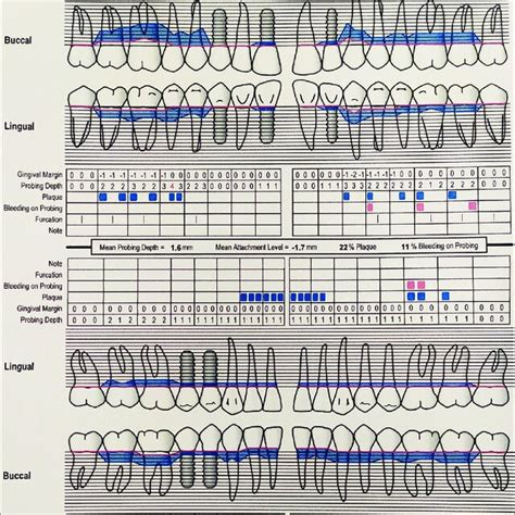 Image result for How to Read a Perio Chart