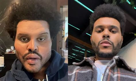 Image result for The Weeknd Botox