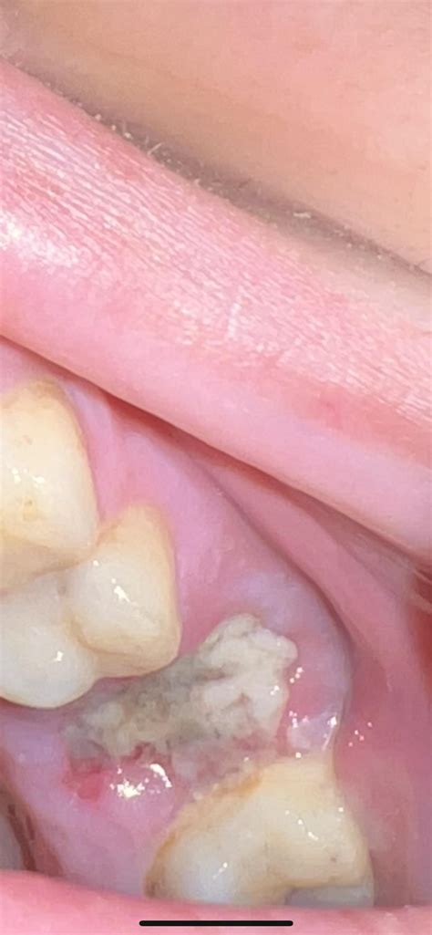 Image result for Infected Tooth Extraction