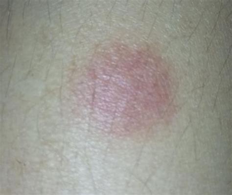 Image result for Cockroach Bites On Humans