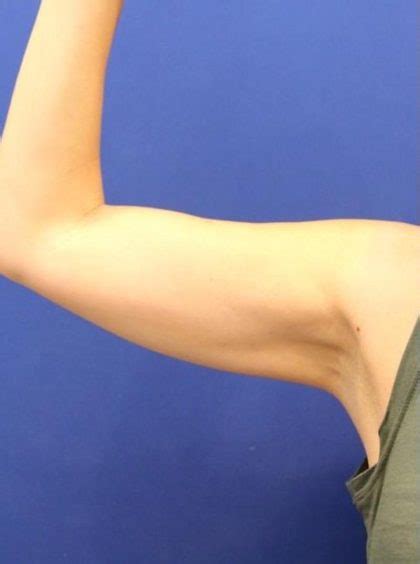 Patient #14234 Body Contouring Before and After Photos New York, NY ...