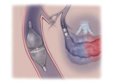 Image result for Embolization Procedure AVM
