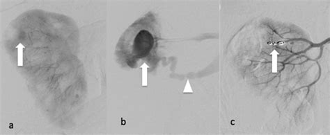 Image result for Nephrogram Phase Timing