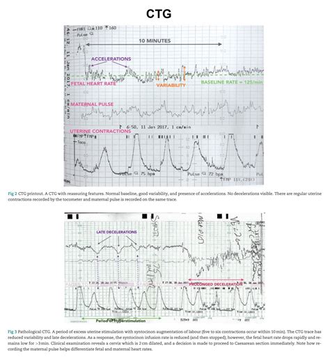 Image result for CTG and Partogram