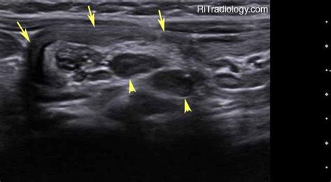 Image result for Intussusception Pseudokidney Sign
