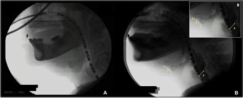 Image result for VFSS Procedure