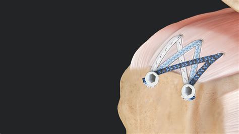 Image result for SpeedBridge Rotator Cuff