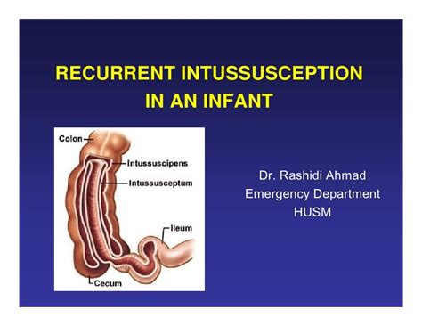 Image result for Intussusception in Arabic