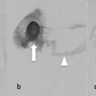 Image result for Nephrogram Phase Timing