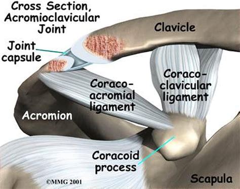 Image result for AC Joint Dysfunction
