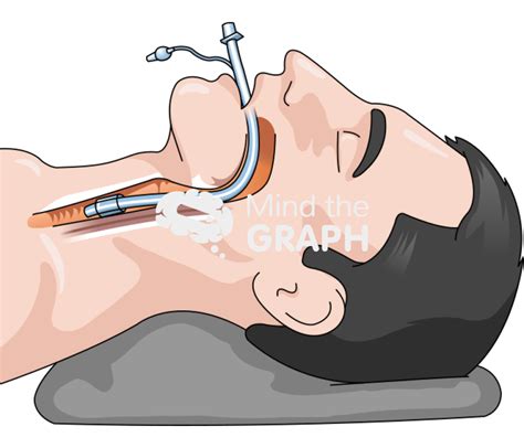 Image result for Intubation Real
