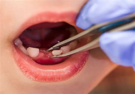 Image result for Tooth Pull Neck