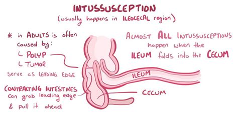 Image result for Pronounce Intussusception