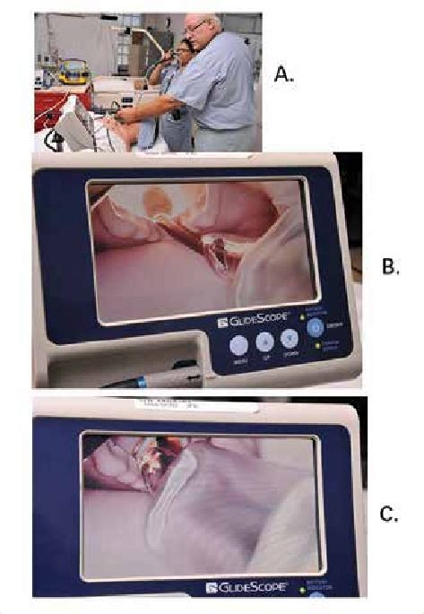 Image result for GlideScope Intubation