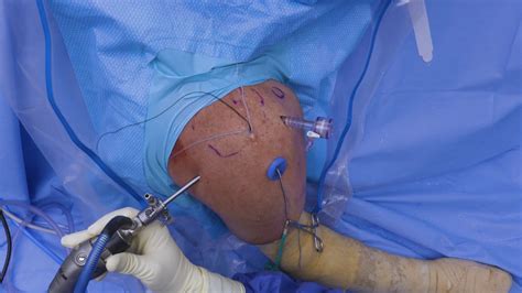 Image result for SpeedBridge Rotator Cuff