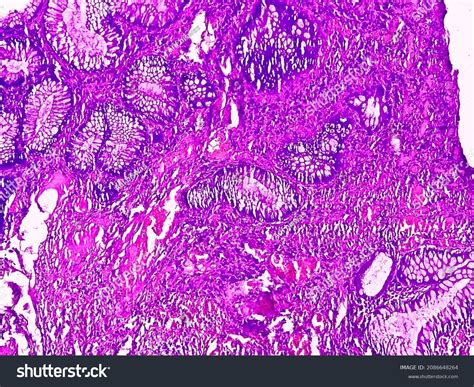 Image result for Colonoscopy Polyps Tutorial