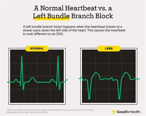 Image result for Incomplete Bundle Branch Block Left Treatment