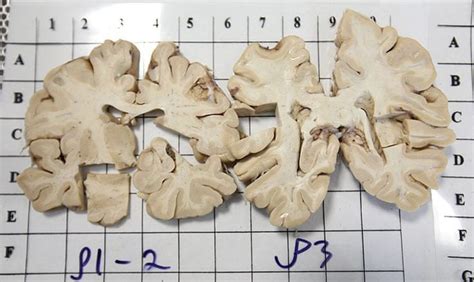 Image result for Human Brain Dissection