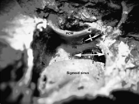 Image result for Ear Dissection Labeled