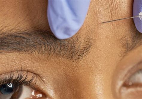 Image result for How Is Botox Injected into the Bladder