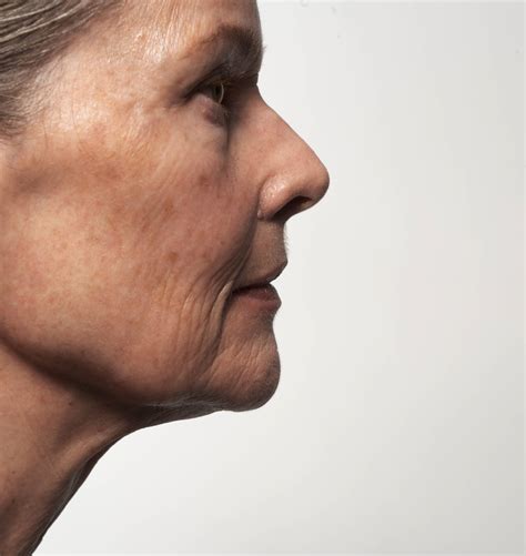 Image result for Types of Pustular Psoriasis