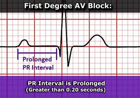Image result for AV Block PR Interval