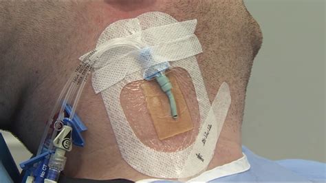 Image result for How to Remove Midline