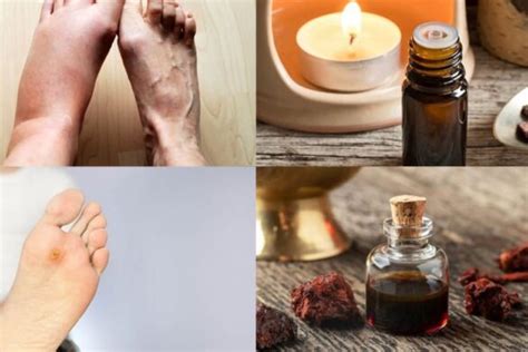 Image result for Drawing Ointment to Remove Splinter