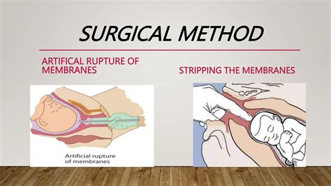 Image result for Obstetrical Version Procedure