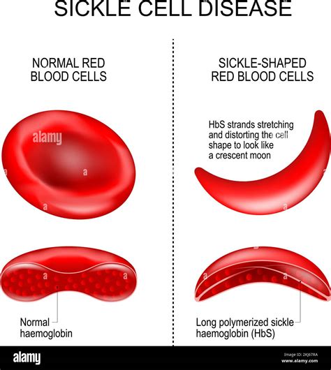 Image result for Sickle Cell Anemia Explained