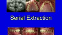 Image result for Serial Extraction Process