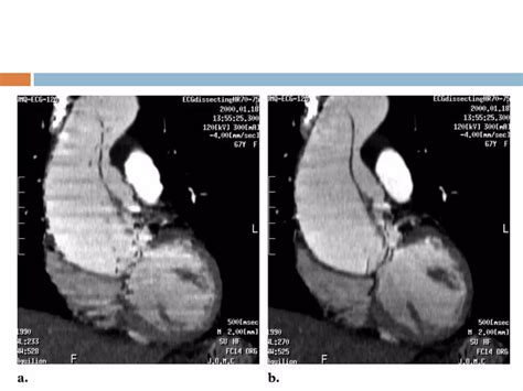Image result for Normal Coronary CT Angiogram