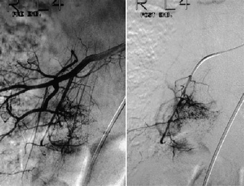 Image result for Spinal Angiogram