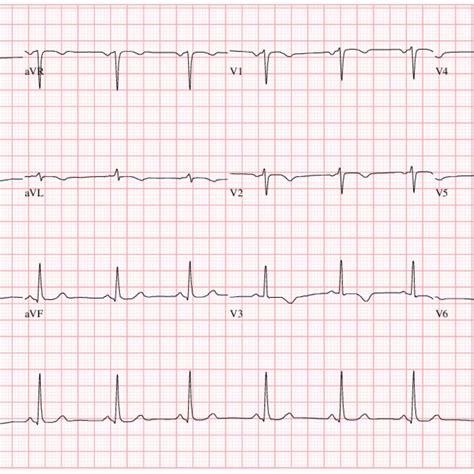 Image result for Normal EcG