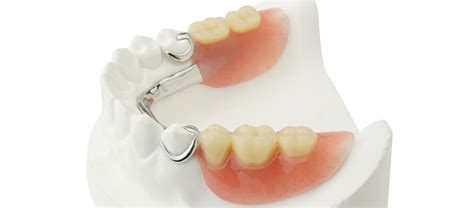 Partial Dentures - Kingston Denture Clinic