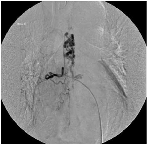 Image result for Spinal Angiogram